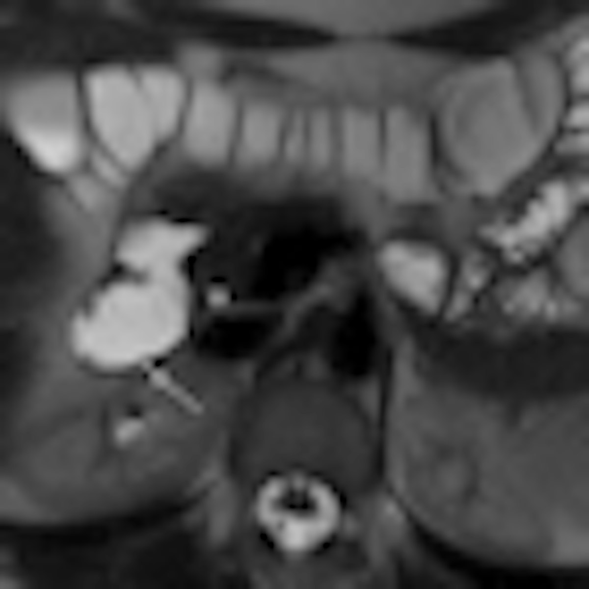 Contrast MRI visualizes bowel damage caused by celiac disease ...