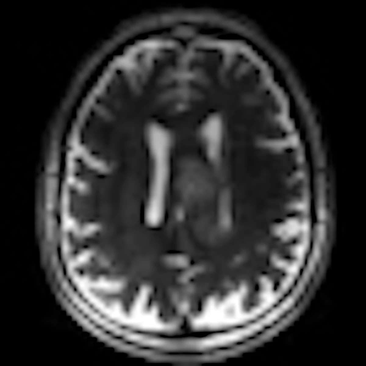 7T MRI protocol shows brain plaques in MS patients | AuntMinnieEurope