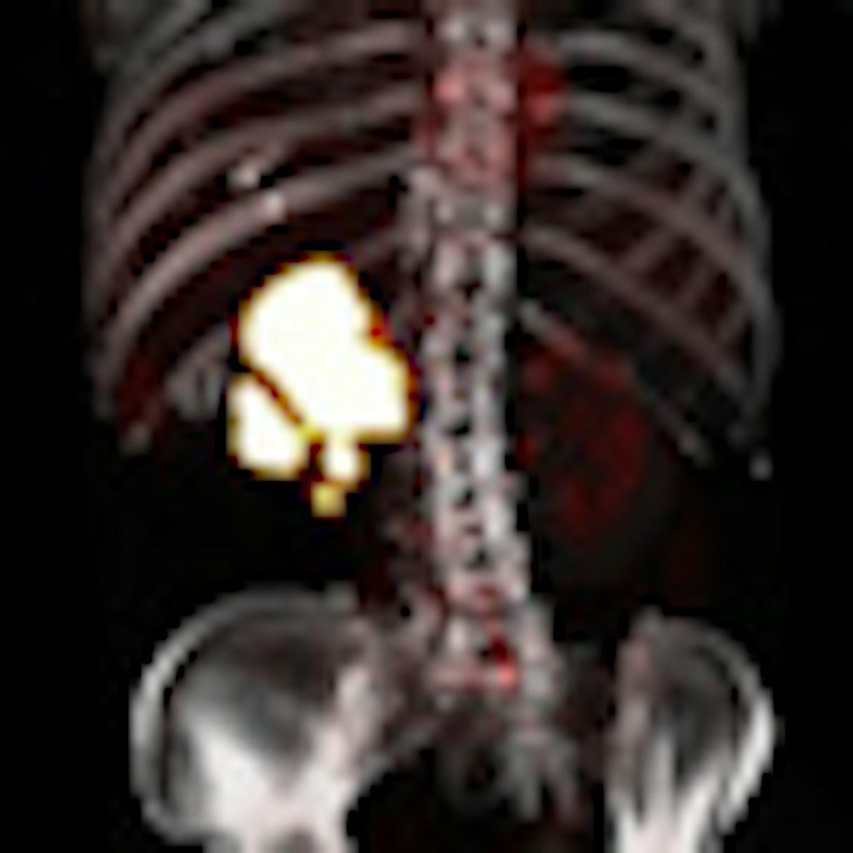ESGAR: Functional imaging progresses in neuroendocrine tumors ...