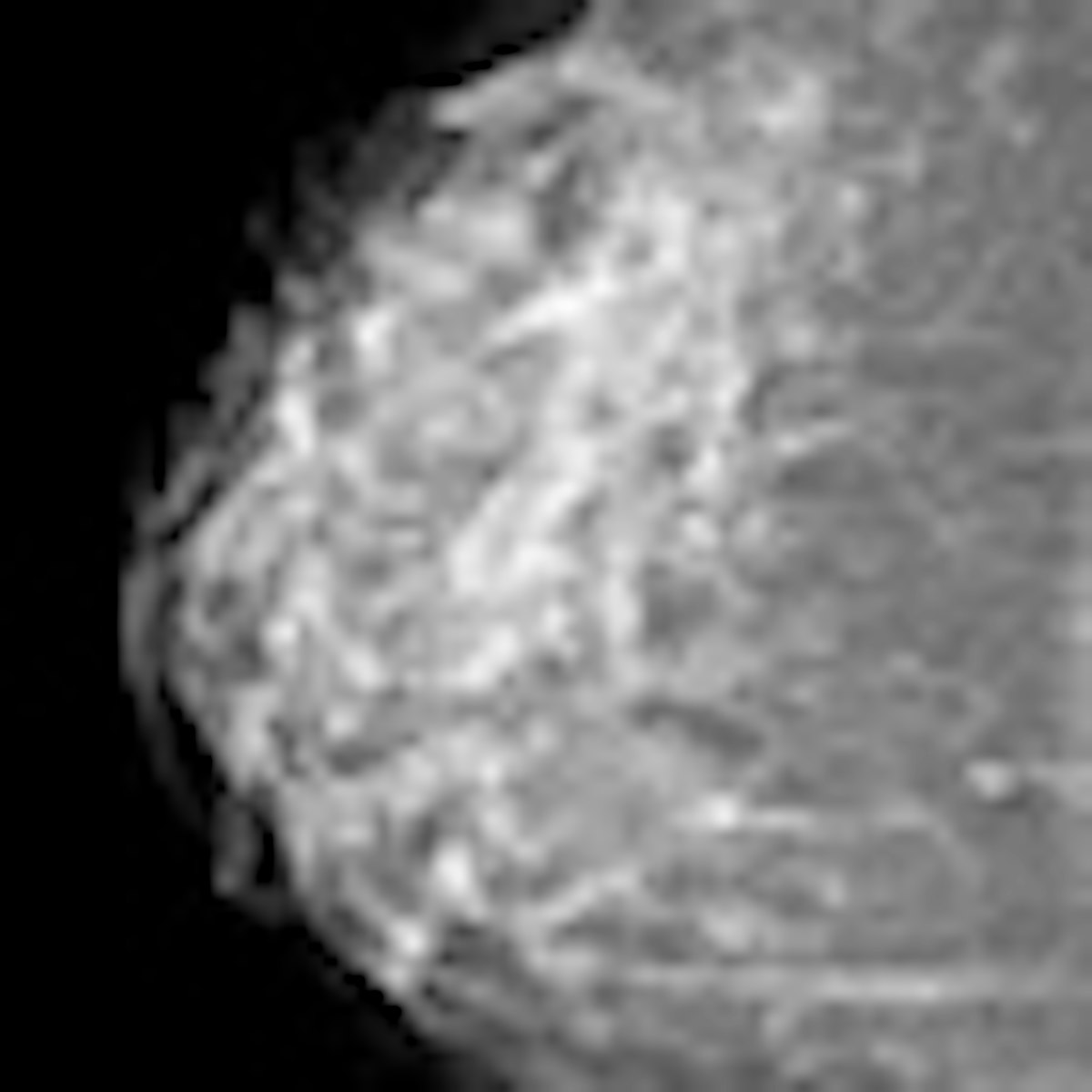 Breast tomo surpasses digital mammography in diagnostic accuracy ...