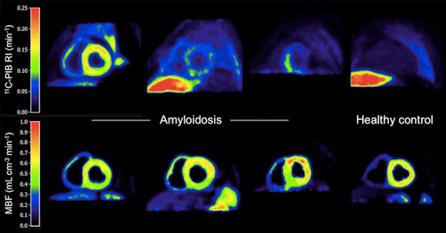 Study shows PiB-PET detects amyloid plaque in heart | AuntMinnieEurope