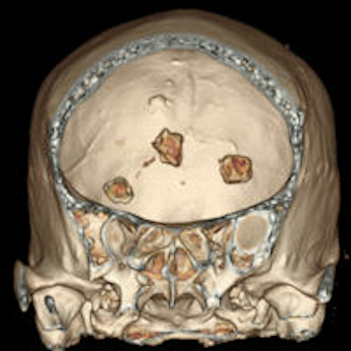 Brain stones: Between a rock and a hard place? | AuntMinnieEurope