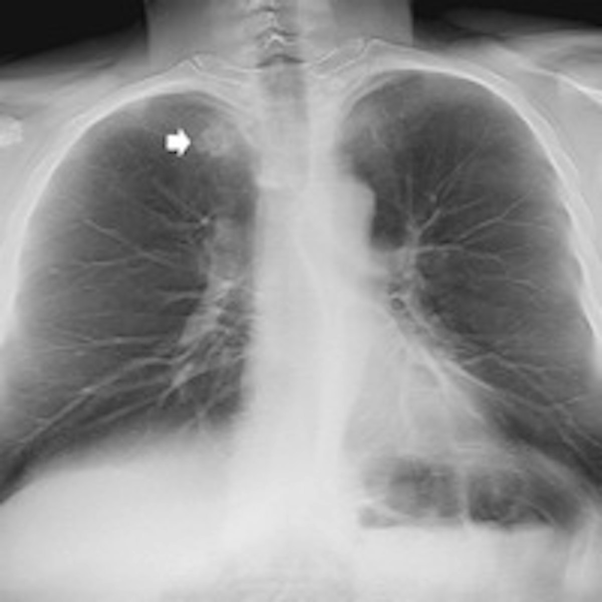 Digital chest tomo saves money, reduces need for CT exam | AuntMinnieEurope