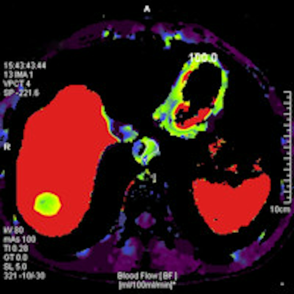 CT perfusion useful for evaluating small esophageal tumors ...