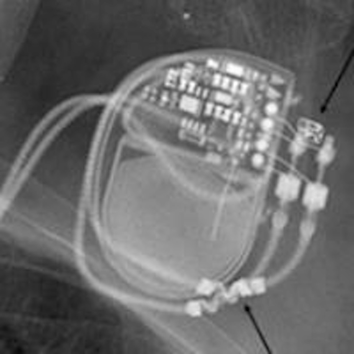 Correct MRI safety protocols bring success with pacemakers ...