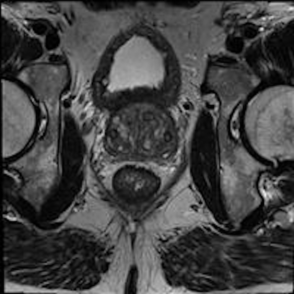 MRI-based prostate CAD shows high sensitivity for cancer | AuntMinnieEurope