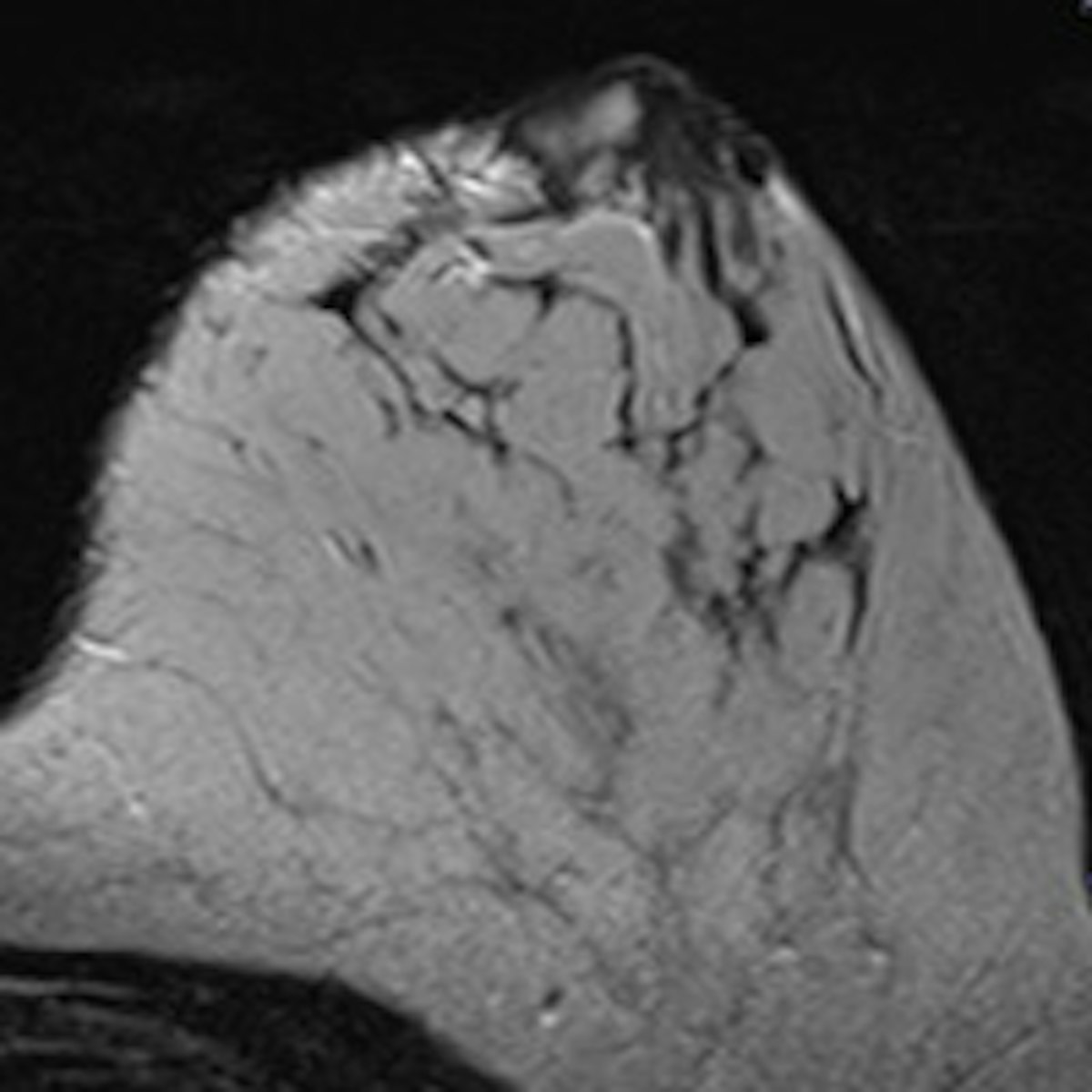 CT, MRI contribute to major shake-up in breast imaging | AuntMinnieEurope