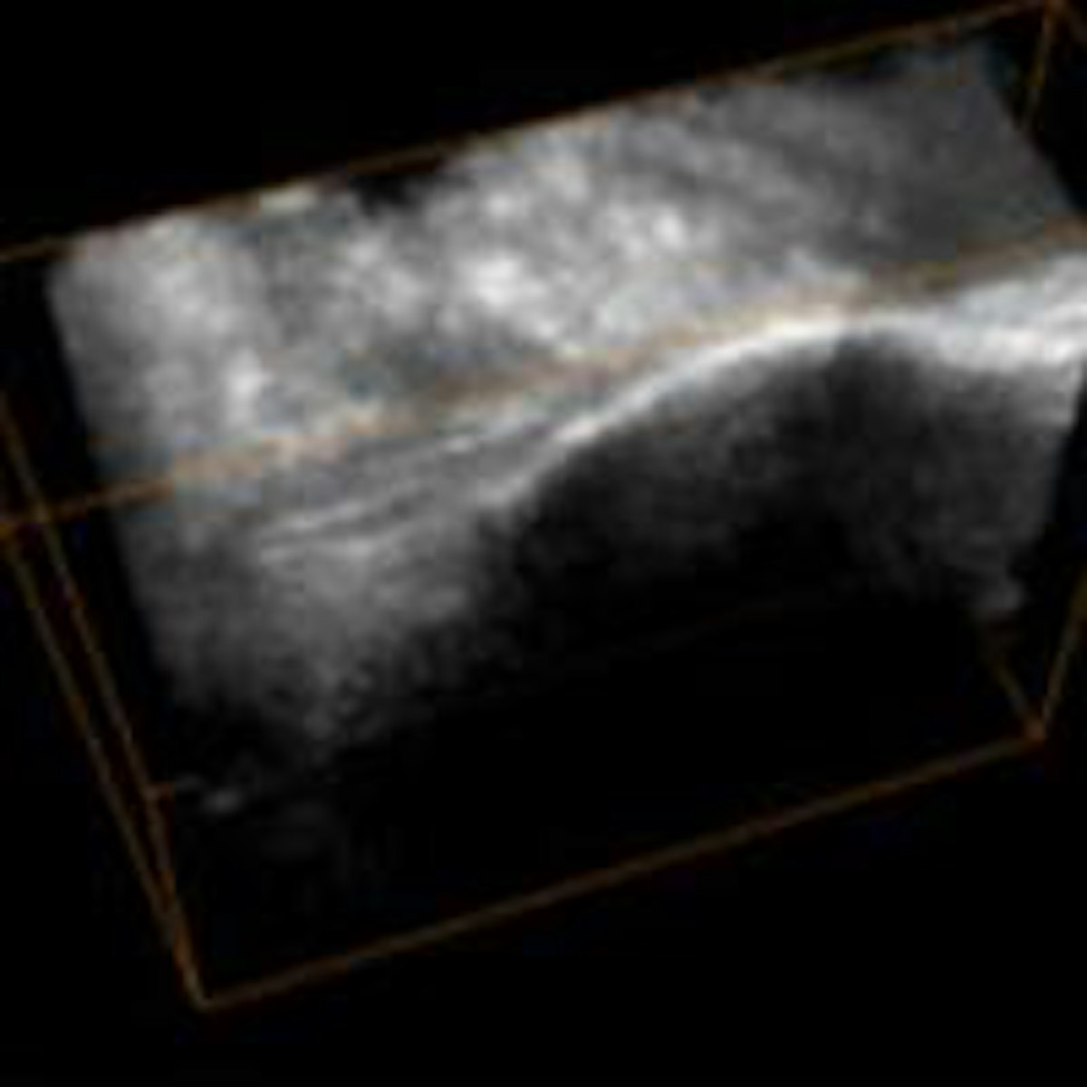 3D bone segmentation displays clinical promise | AuntMinnieEurope