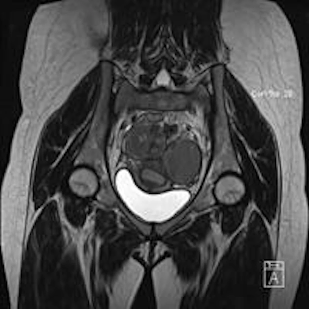 Pelvic MRI for endometriosis can be performed anytime | AuntMinnieEurope