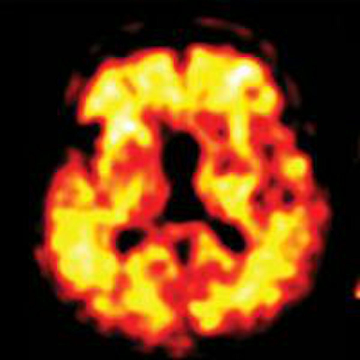Lancet: Dementia imaging on cusp of a revolution | AuntMinnieEurope