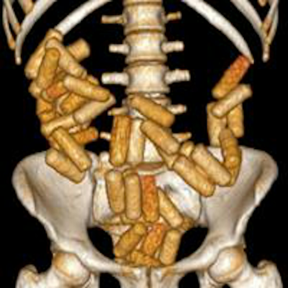 Imaging holds key in war on drug mules | AuntMinnieEurope