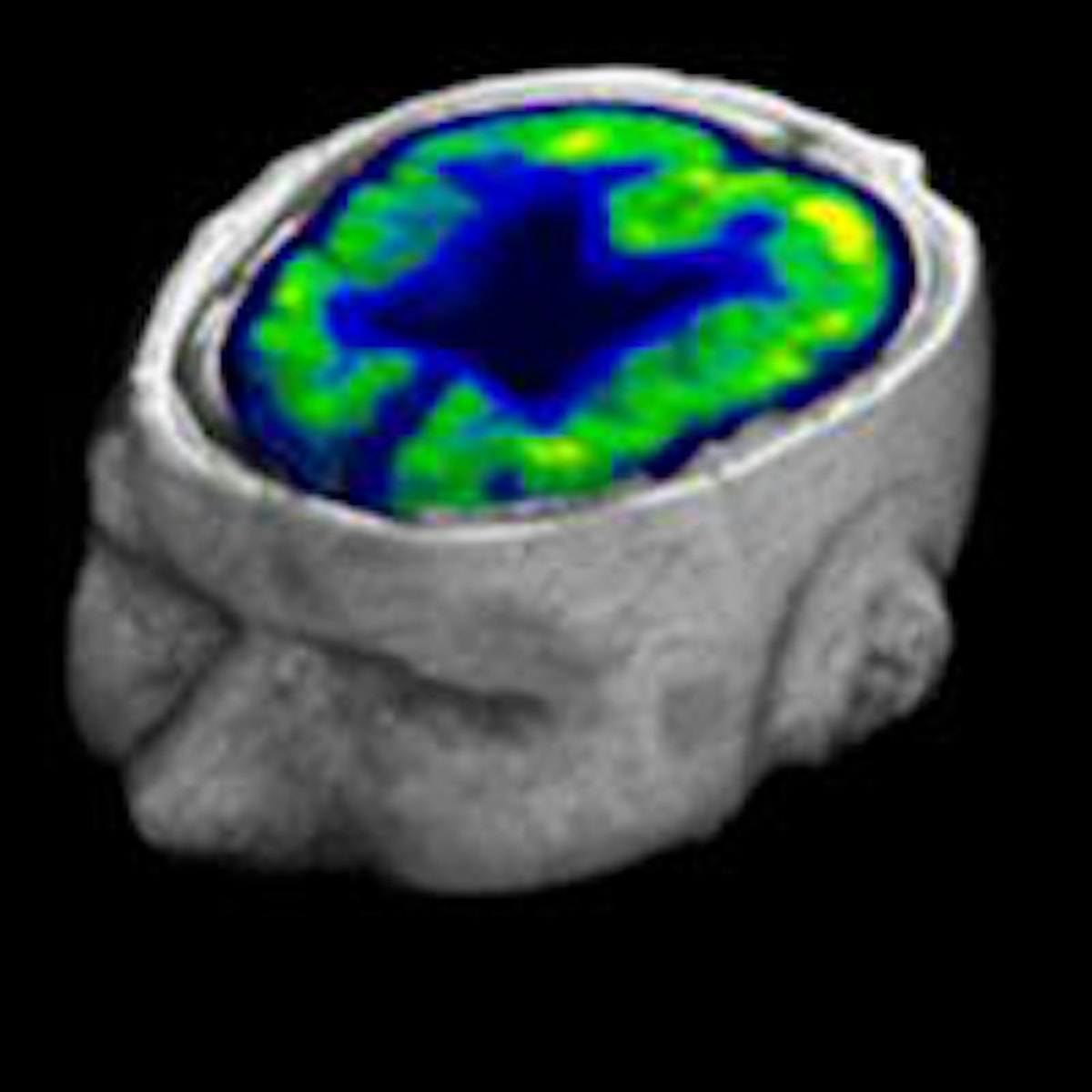 FDG-PET helps accurately assess unconscious patients | AuntMinnieEurope