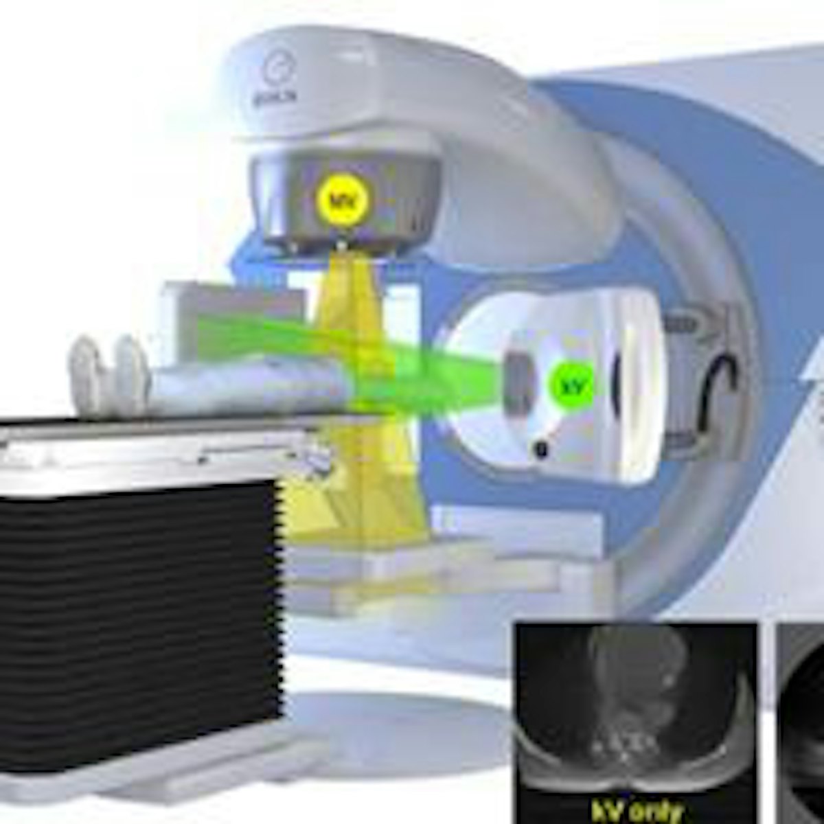 MR-guided radiotherapy: How great is the need? | AuntMinnieEurope
