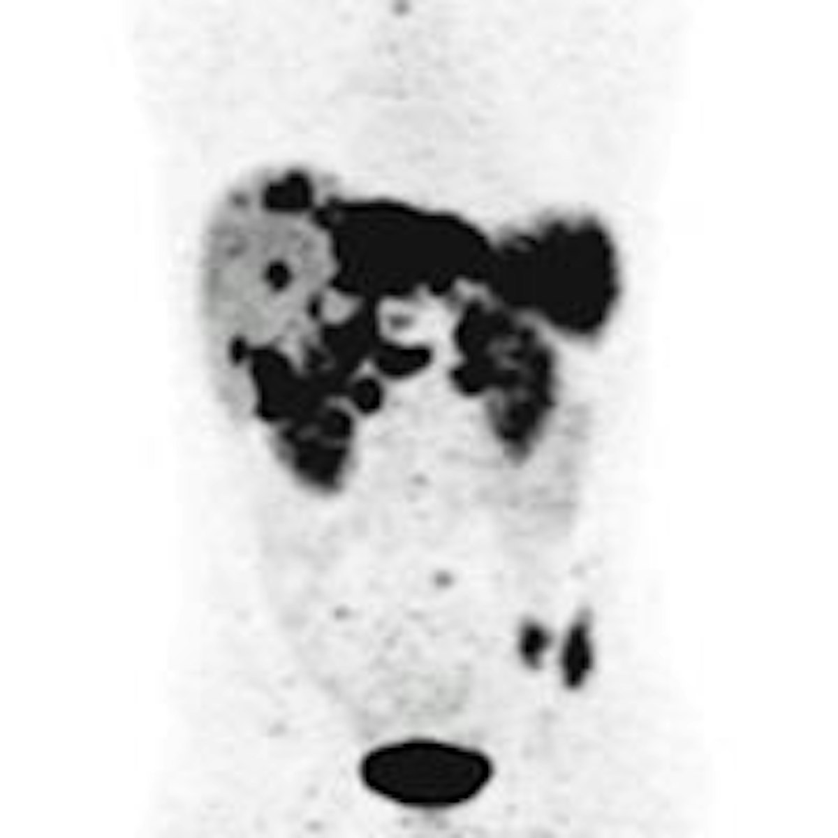 FDG-PET adds to gallium-68 scans for neuroendocrine tumors ...