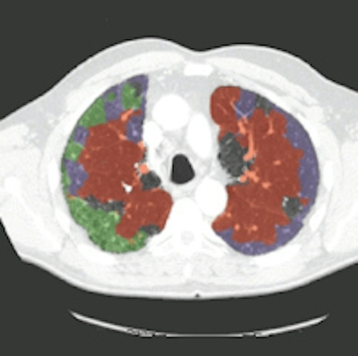 Texture classification eases lung CT analysis | AuntMinnieEurope