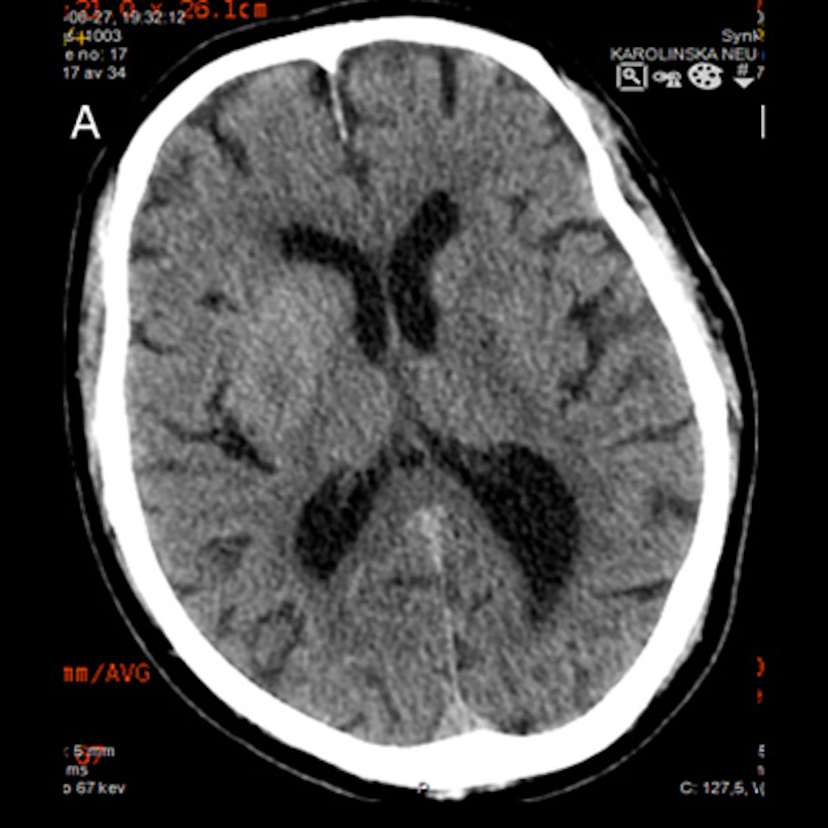CT techniques for stroke demystified | AuntMinnieEurope