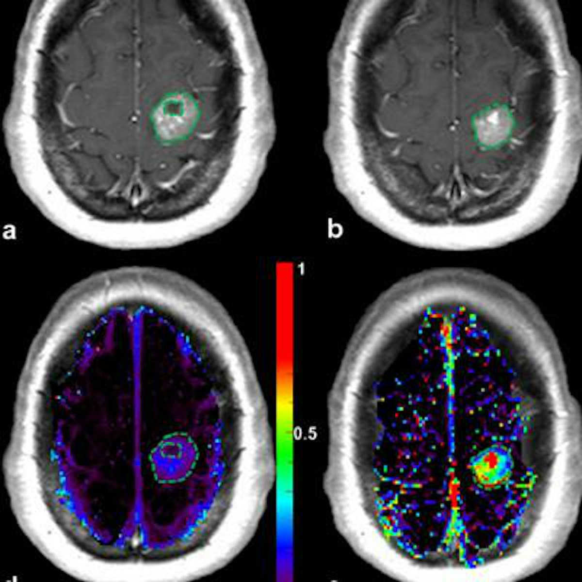 Use DCE-MRI, pharmacokinetics for brain metastases | AuntMinnieEurope