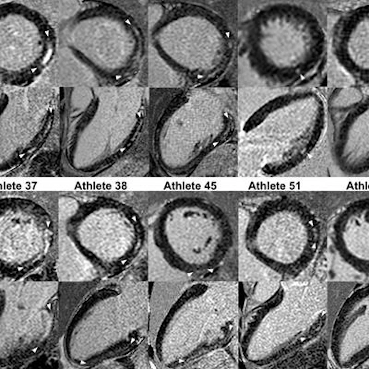 MRI discovers heart damage among male triathletes | AuntMinnieEurope