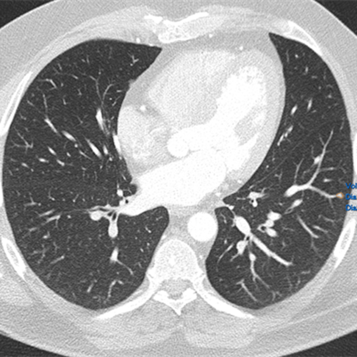 3D volumetry shows promise in lung but requires care | AuntMinnieEurope