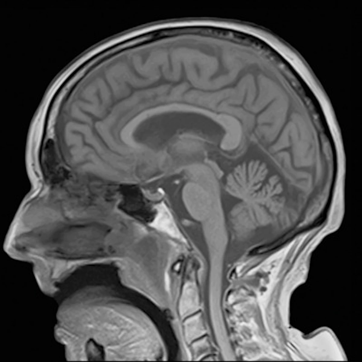 Functional MRI assists in somatosensory cortex | AuntMinnieEurope