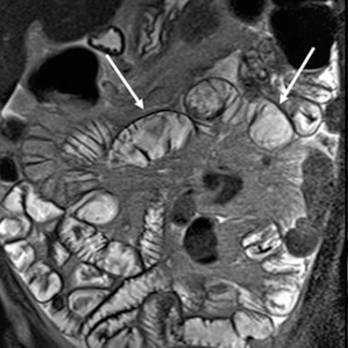 10 top tips on best use of MR enterography in small bowel ...
