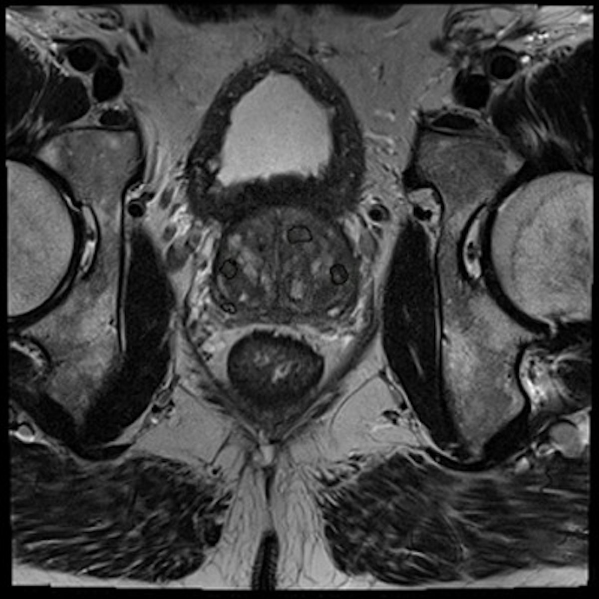 PRECISION trial lauds MRI for prostate cancer detection | AuntMinnieEurope