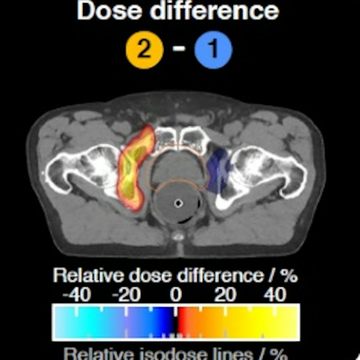 Dual-energy CT proves optimal for proton planning | AuntMinnieEurope