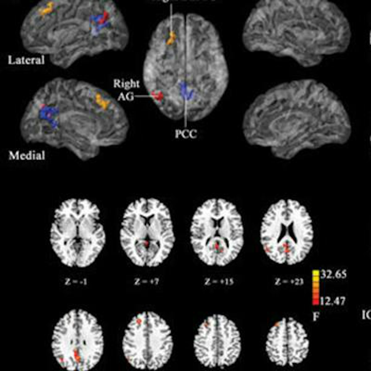 Imaging reveals subtle brain alterations in gaming addiction ...