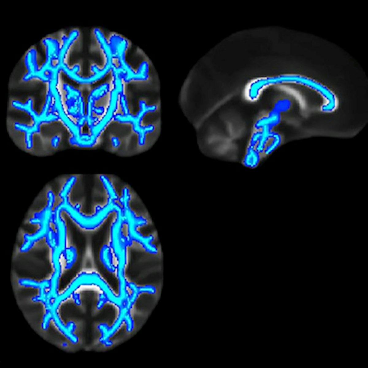 DTI-MRI reveals alcohol damage to brain after abstinence | AuntMinnieEurope