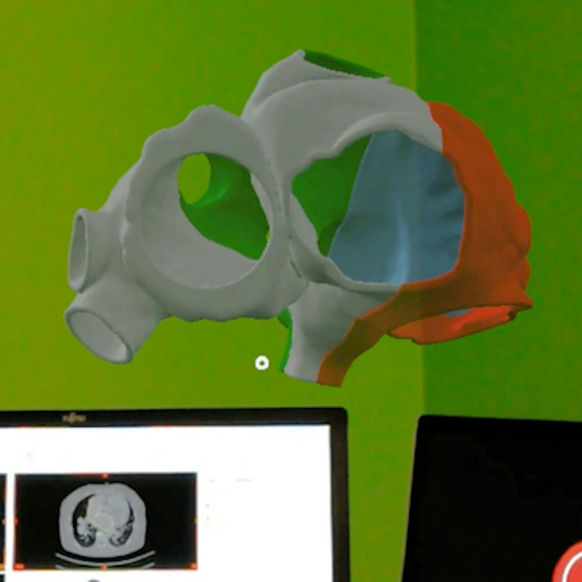 Milan group uses AR, 3D printing to assist in heart surgery ...