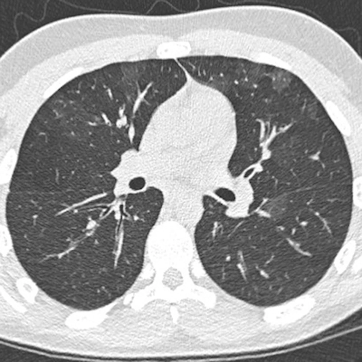 CT highlights risk of lung inflammation from vaping | AuntMinnieEurope