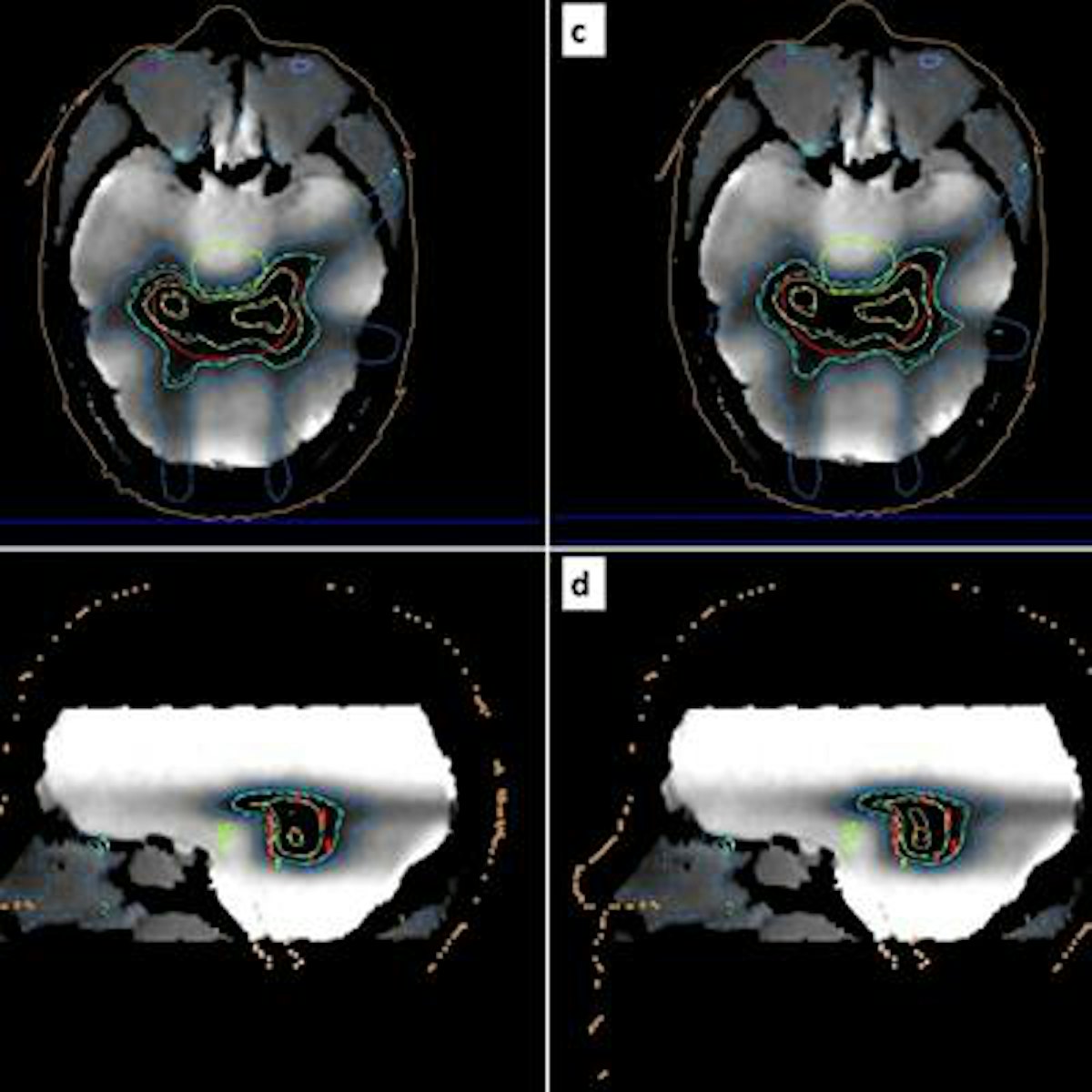 MRI-guided radiotherapy progresses in clinical arena | AuntMinnieEurope