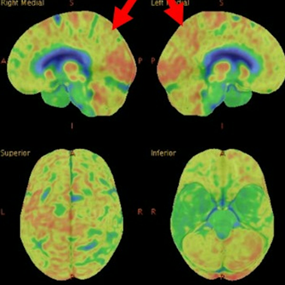 FDG-PET displays its prowess in dementia detection | AuntMinnieEurope