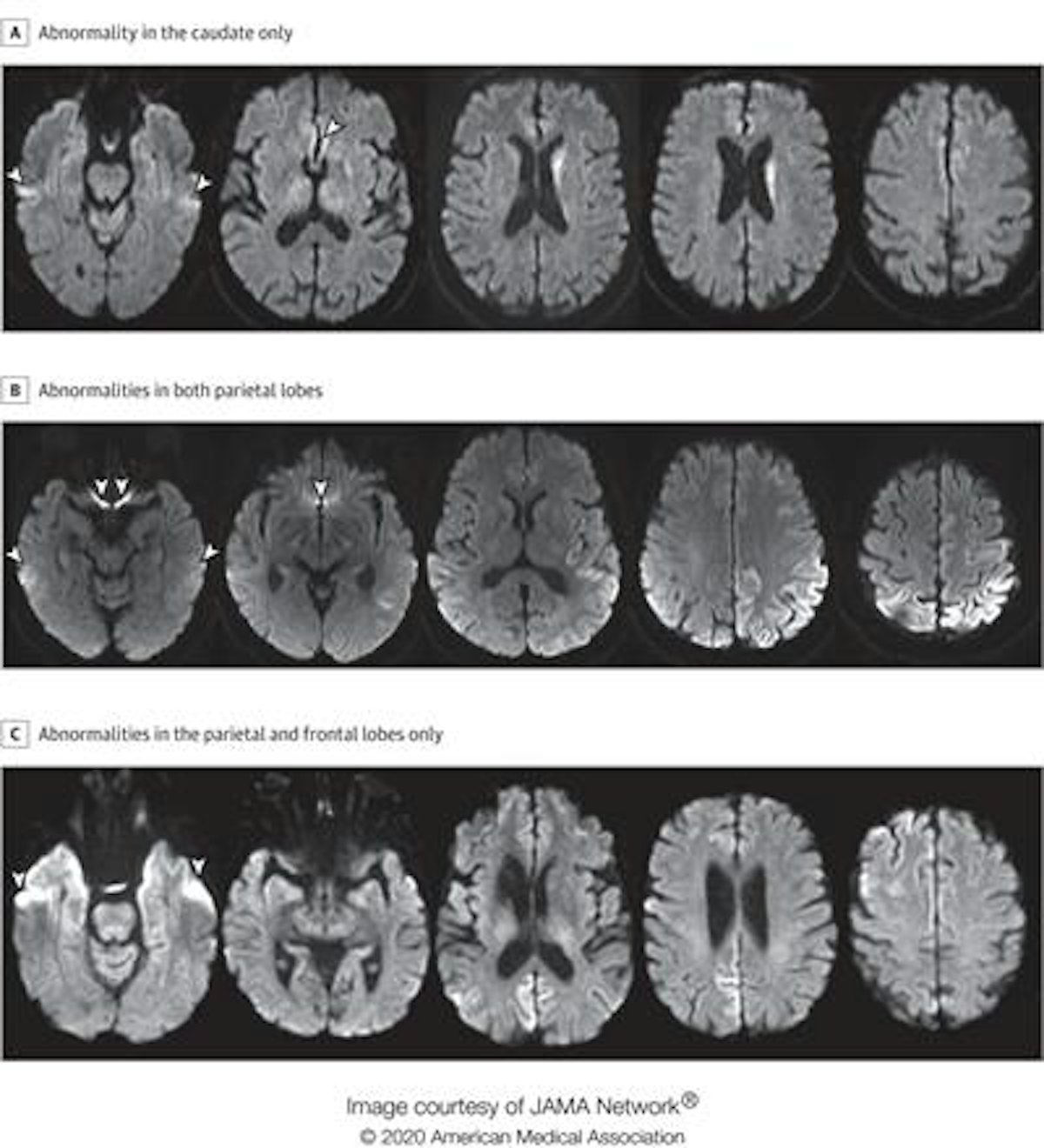 New MRI scoring criterion helps diagnose prion disease | AuntMinnieEurope
