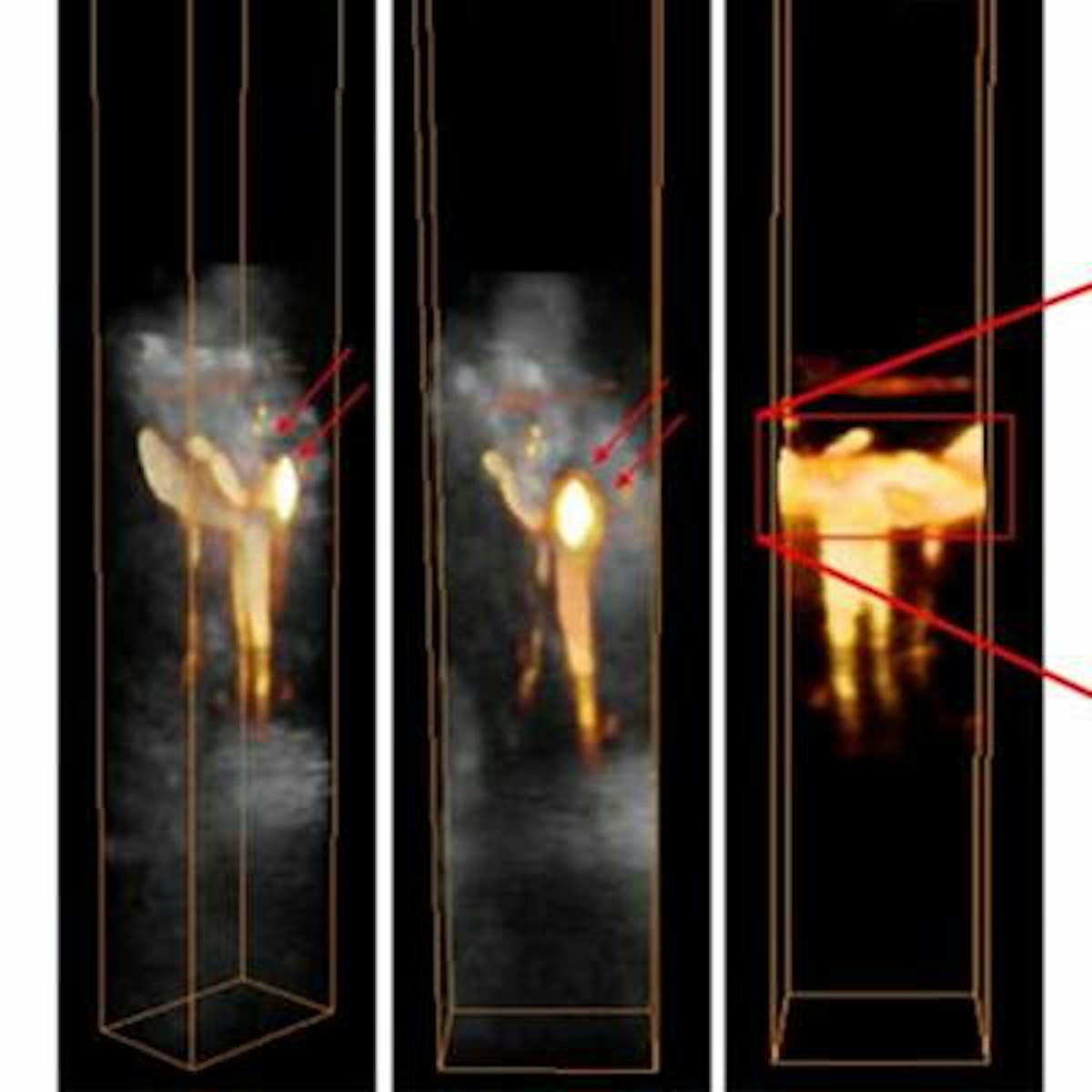 3D ultrafast ultrasound quantifies coronary blood flow | AuntMinnieEurope