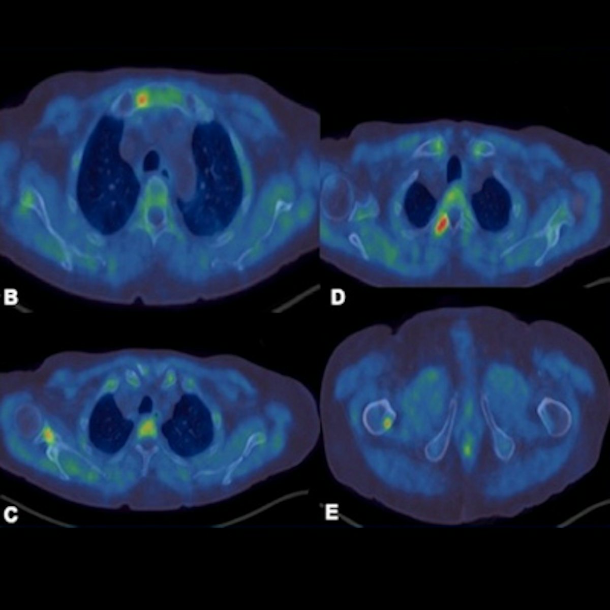 SPECT, PET tracers boost detection of skeletal metastases ...