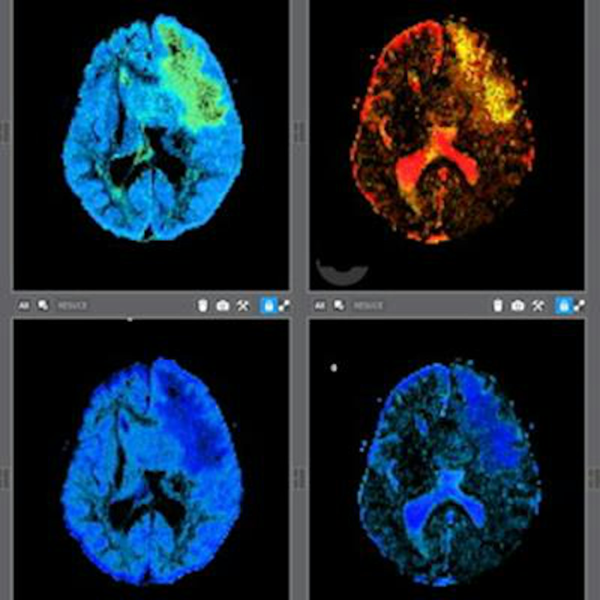 Random Walk debuts MRI analysis software at ISMRM 2020 | AuntMinnieEurope