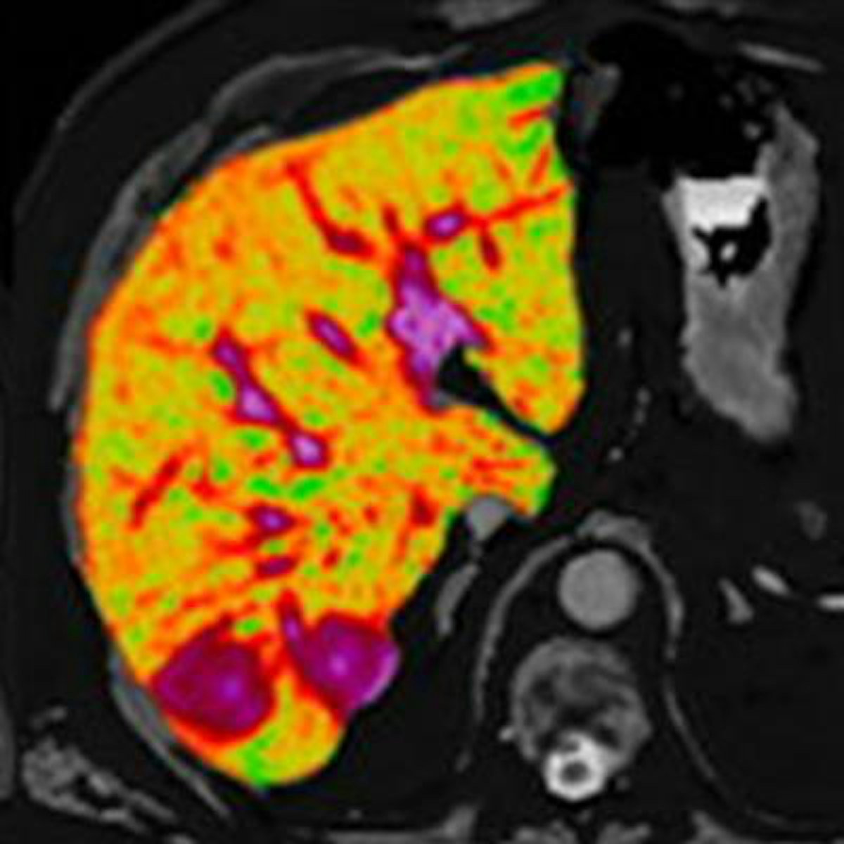 Perspectum MRI software helps guide liver surgeries | AuntMinnieEurope