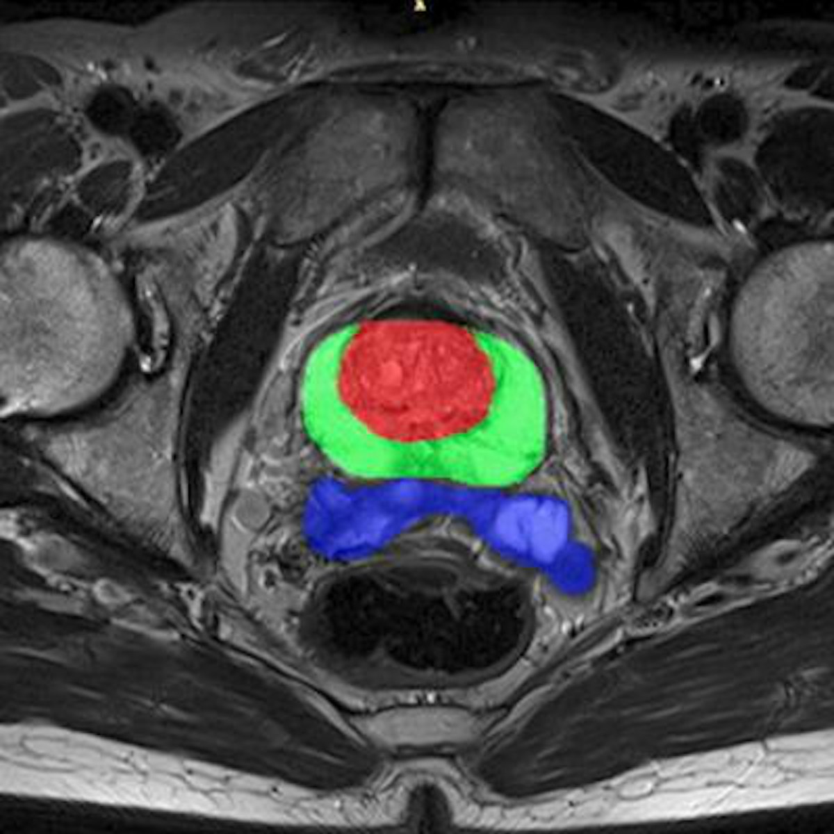 Quibim's AI software for prostate MRI cleared by FDA | AuntMinnieEurope