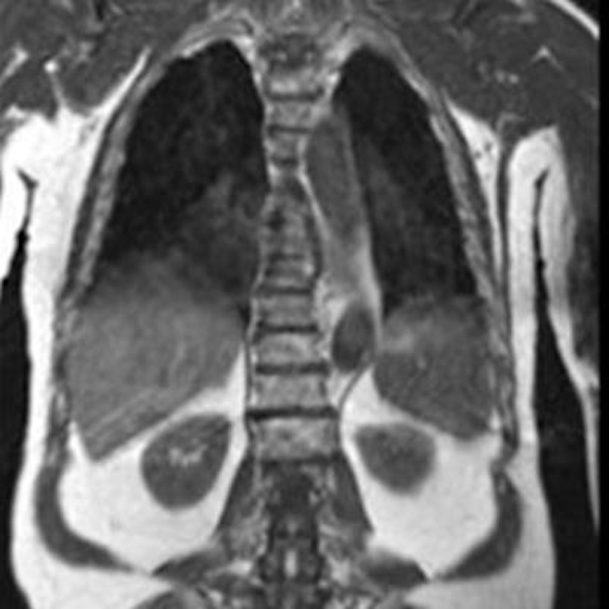 Whole-body MRI helps cancer patients where FDG-PET fails | AuntMinnieEurope