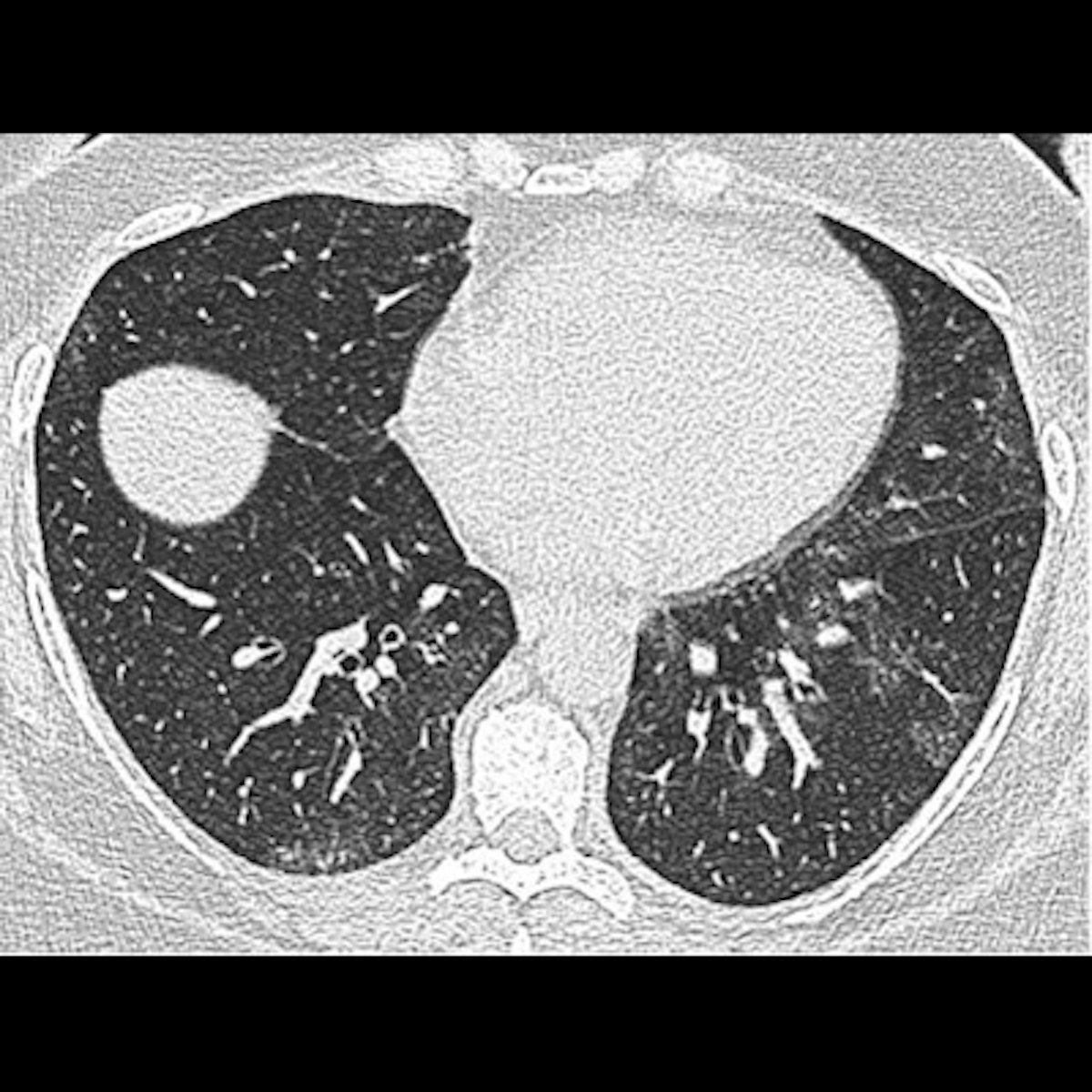 Thoracic CT proves value for monitoring obese patients' health ...