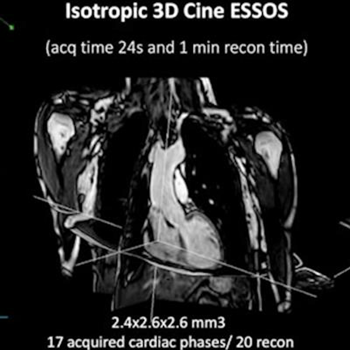 Philips highlights new fast cardiac MRI protocol | AuntMinnieEurope