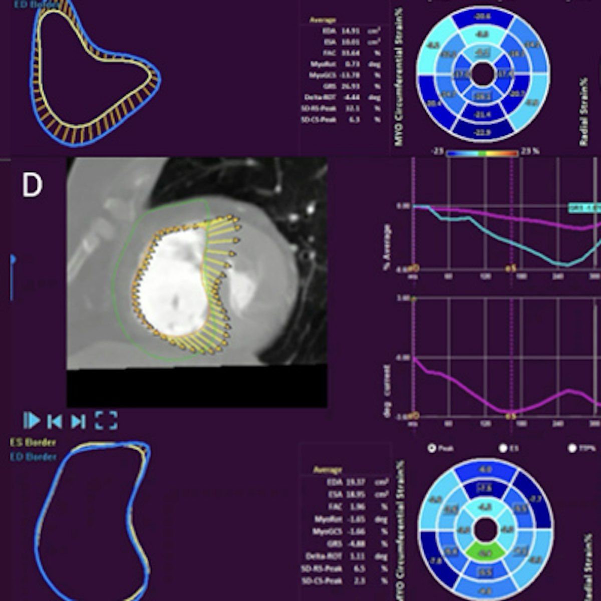 Cardiac CT tissue tracking proves value in pulmonary embolism ...