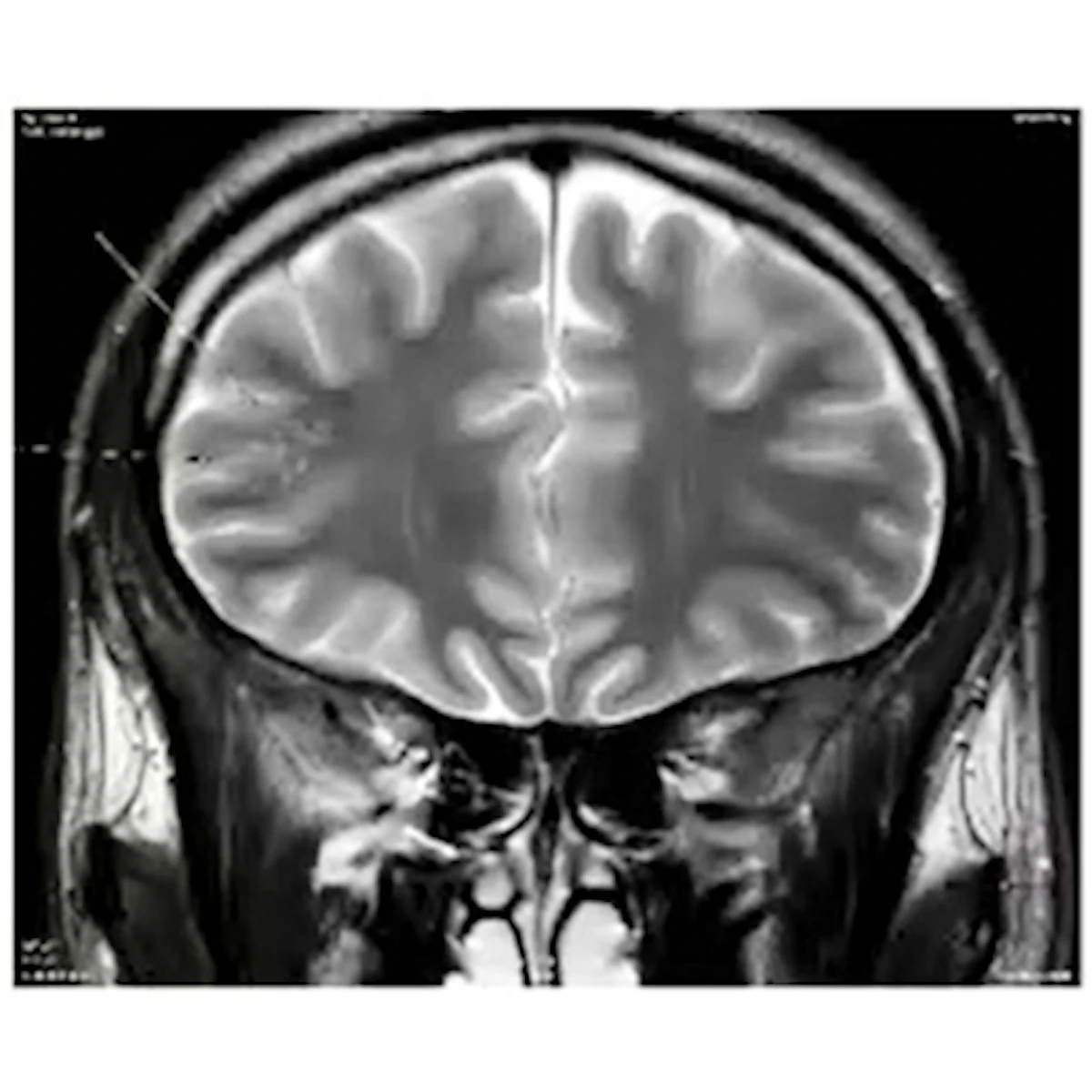 Imaging makes sustained progress in psychiatric disorders ...