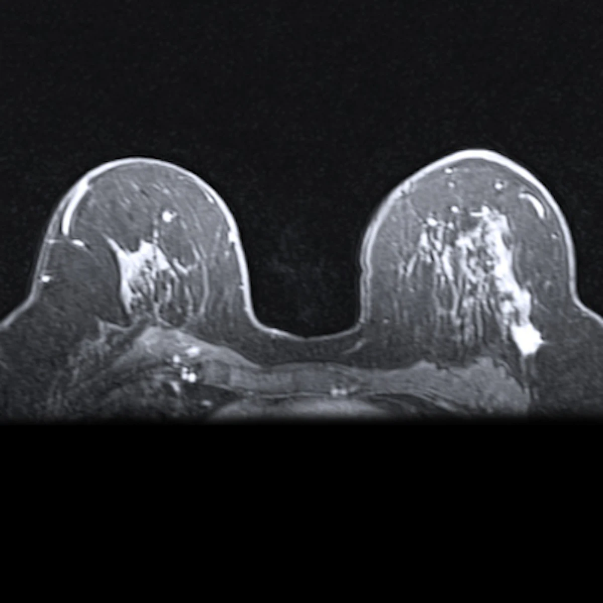 Austrian team unveils findings on abbreviated breast MRI | AuntMinnieEurope