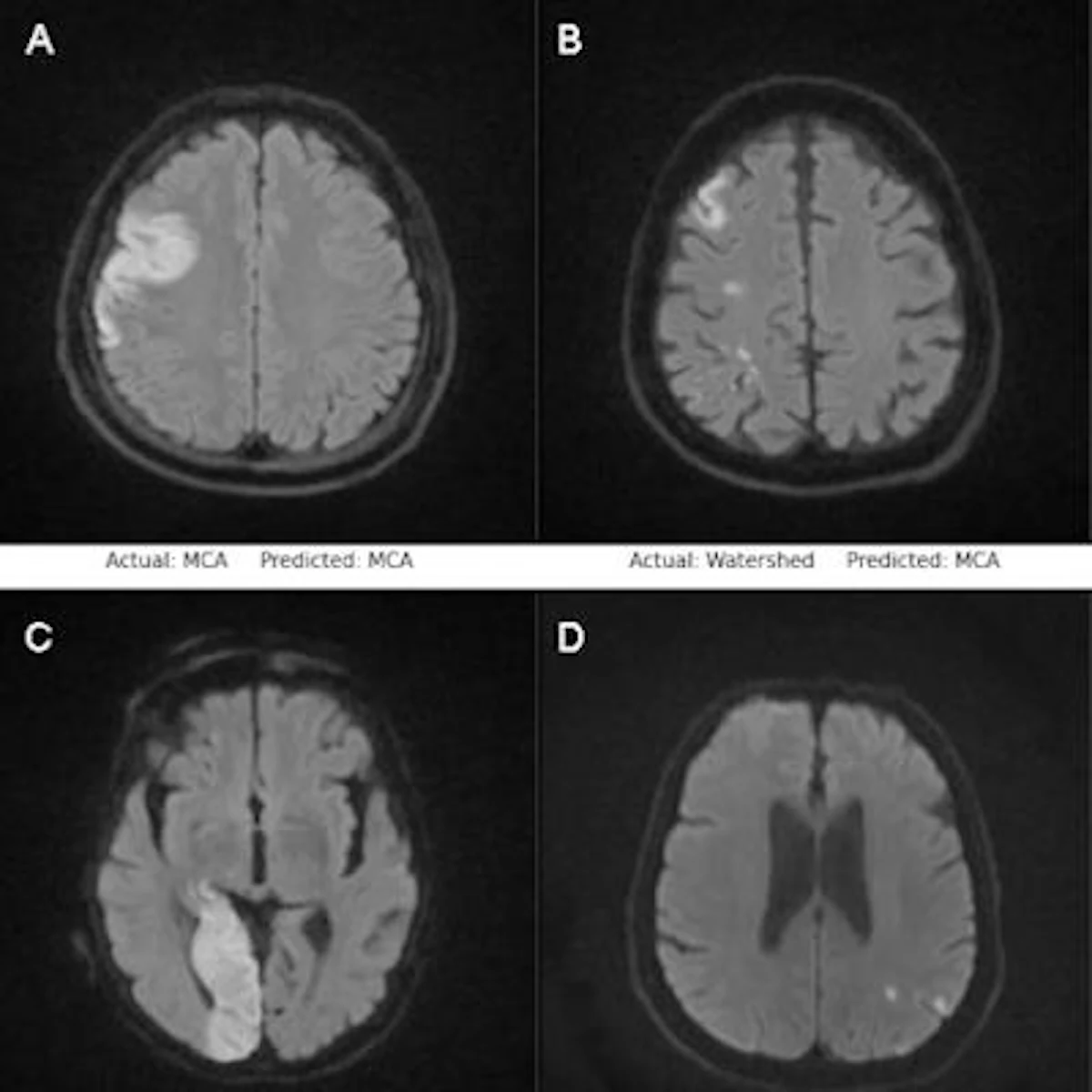 Deep-learning methods can help diagnose stroke on MRI | AuntMinnieEurope