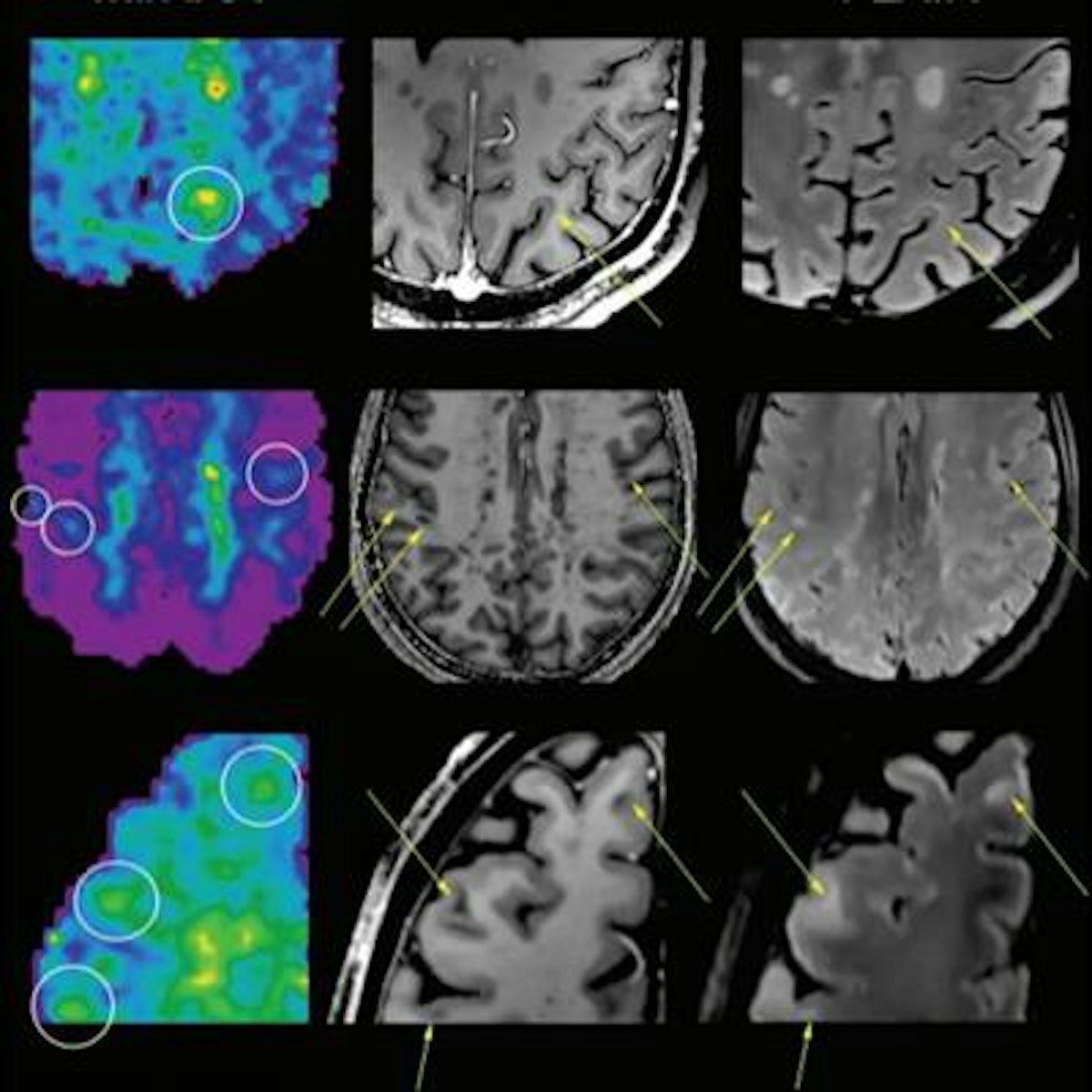 Viennese team highlights brain changes in multiple sclerosis ...