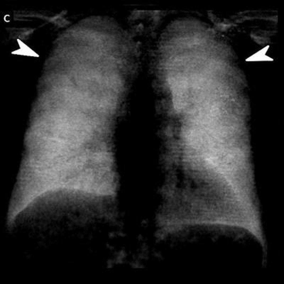 Munich team uses dark-field x-ray for COVID-19 pneumonia detection ...