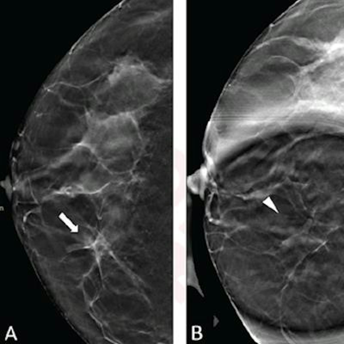 Momentum gathers for DBT plus synthesized mammography | AuntMinnieEurope