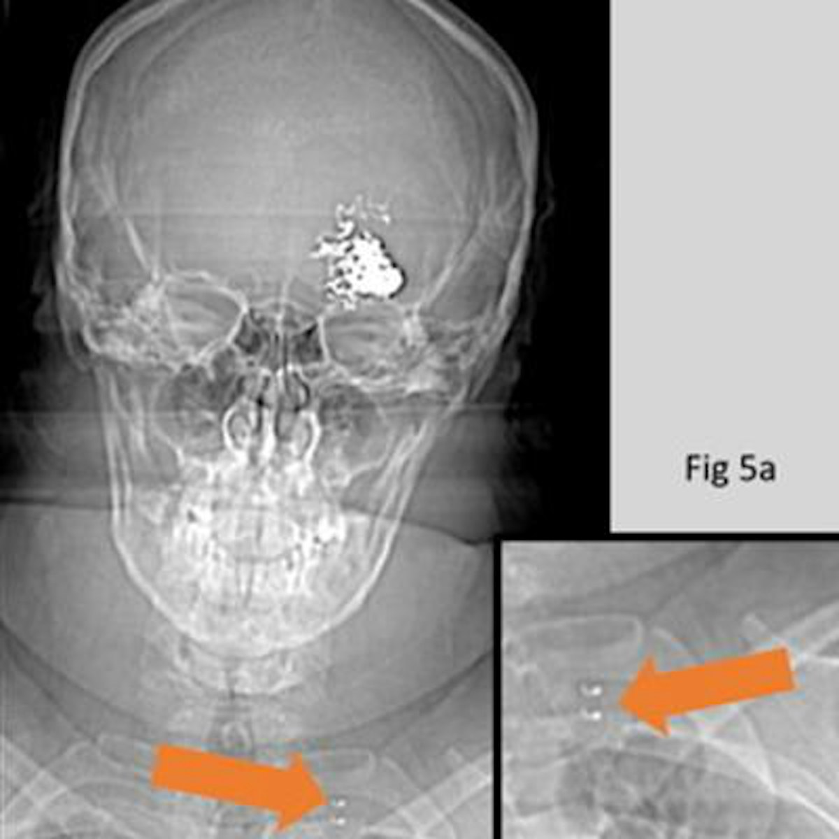 Low-dose CT scout images prove value in MRI safety screening ...